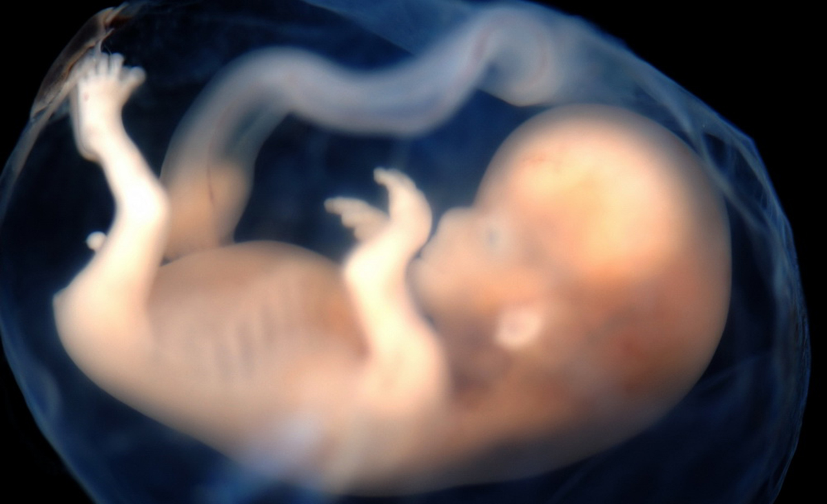 Fetus In Fetu A Baby Inside Of Another Pregnancy Articles Family