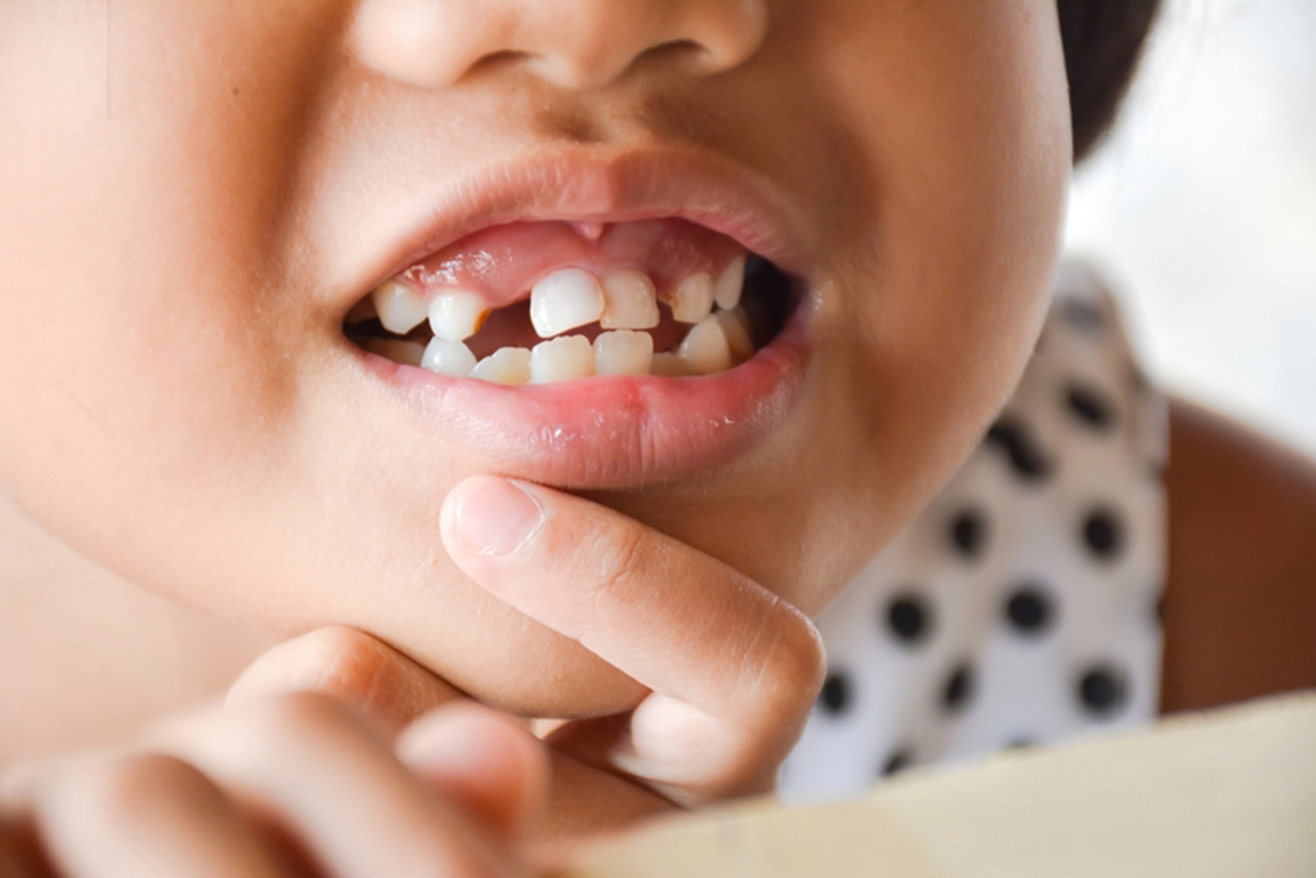 When Should Your Child s Milk Teeth Be Extracted Will That Affect Your 