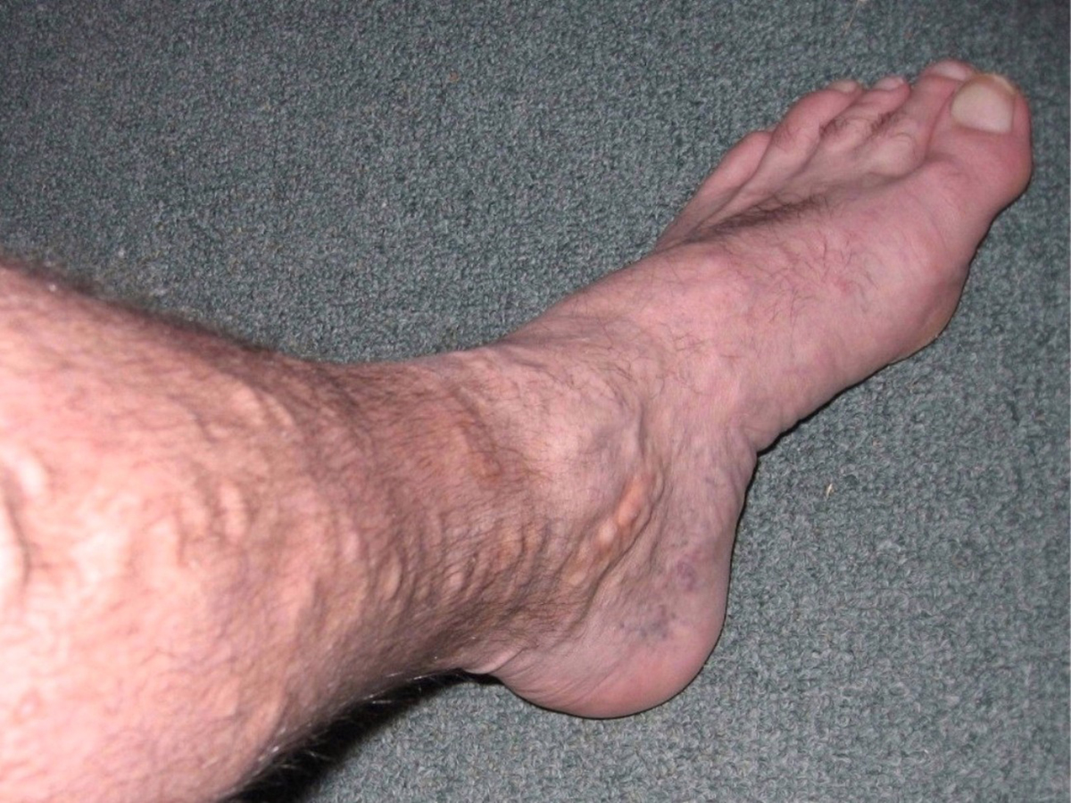 Spider Veins On Legs Treatment General Center SteadyHealth