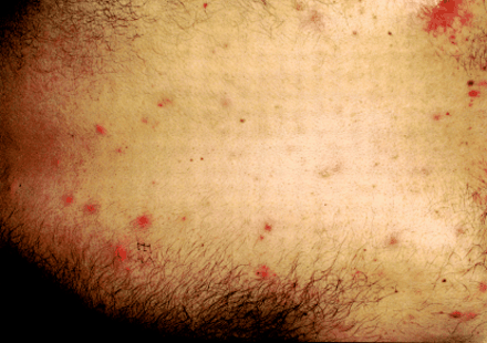 Behcet's Syndrome | Autoimmune diseases articles | Body & Health ...