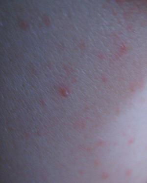 Heat Rash Chest
