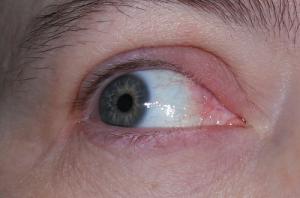Is eye stye contagious | General center | SteadyHealth.com