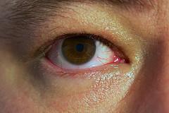 Red dots around eyes | General center | SteadyHealth.com