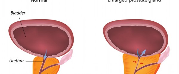 Distended bladder facts | General center | SteadyHealth.com